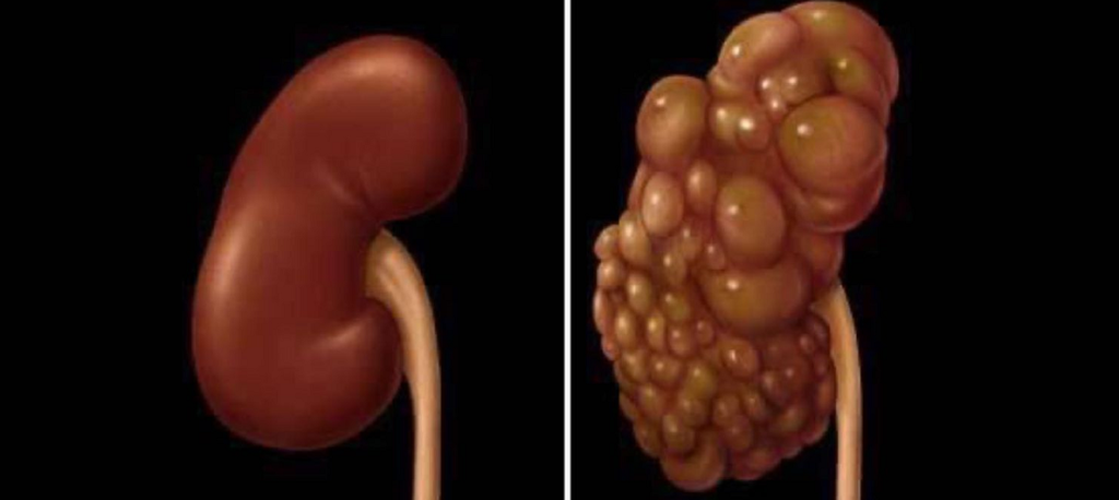 12 sintomas de doenças renais que você deve conhecer - Educadores